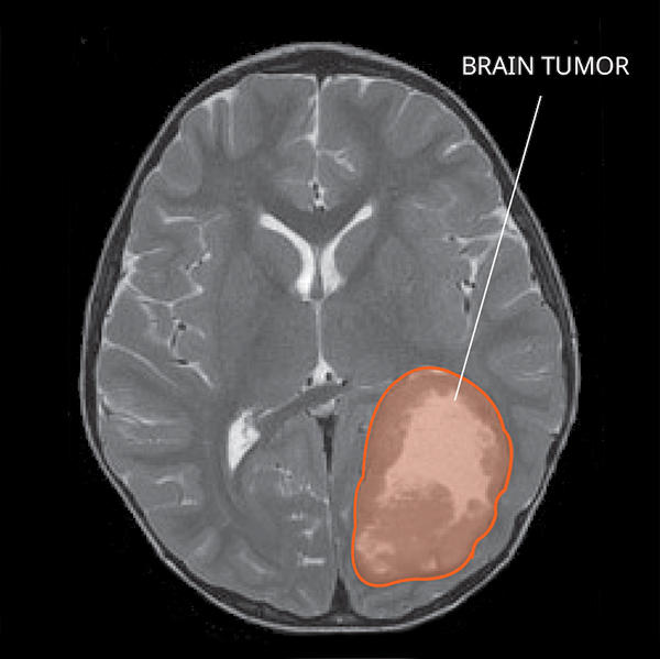 Primitive Neuro-Ectodermal Tumors (PNET) - National Cancer Institute